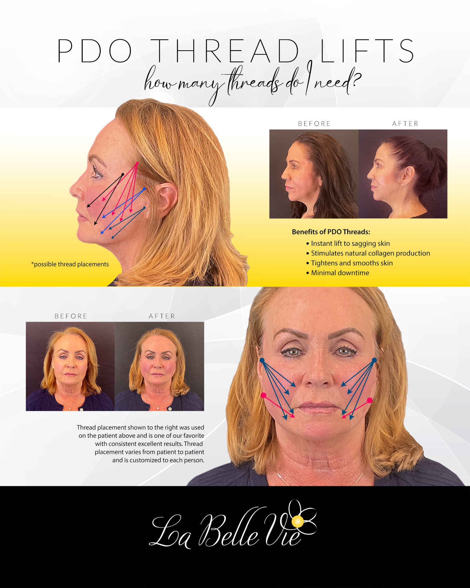 PDO Thread Lifts in Draper, UT | La Belle Vie Medical Care